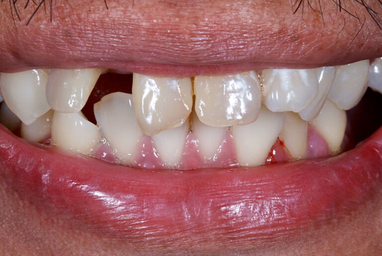 Before & After Photos | Big Sky Smiles & Sedation | Missoula, MT